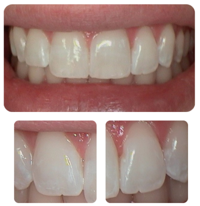 ICON Resin Infiltration | Encore Family Dentistry | Marietta-East Cobb