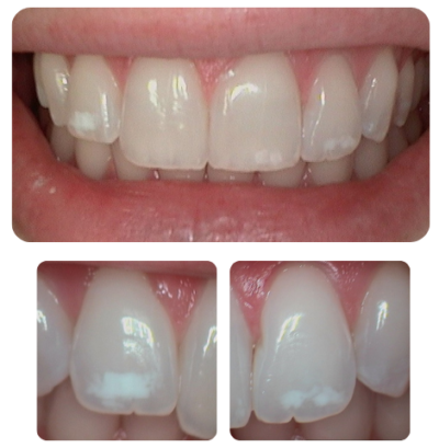 ICON Resin Infiltration | Encore Family Dentistry | Marietta-East Cobb